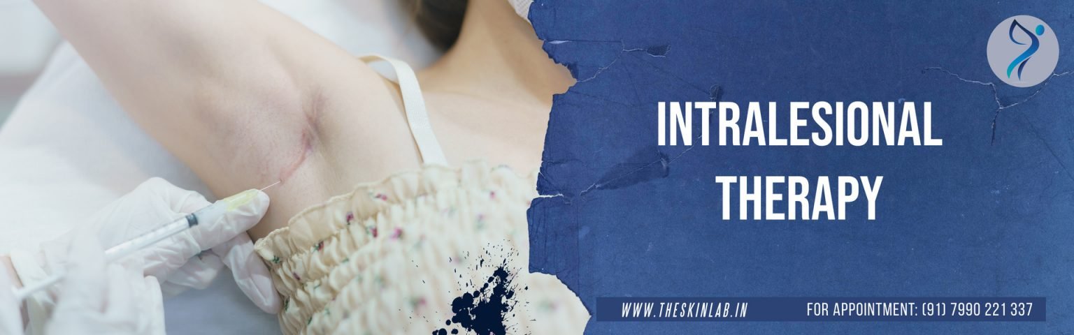 Intralesional Therapy - The Skin Lab