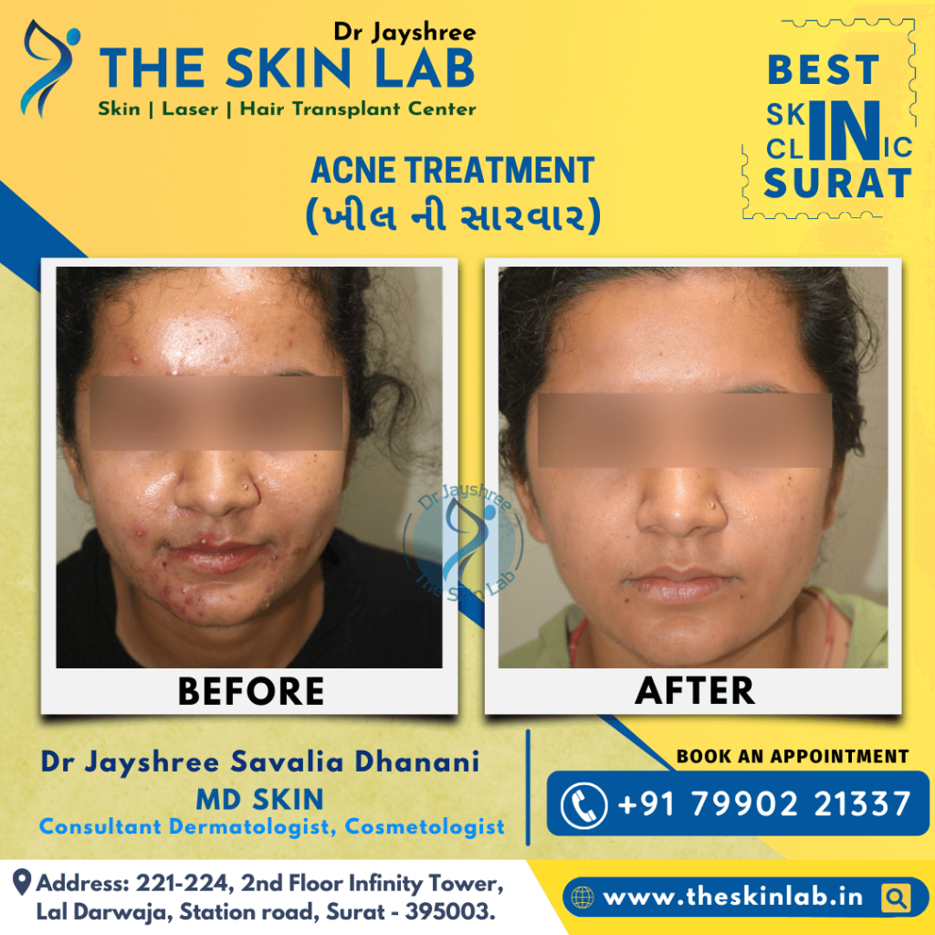 Treatment Results - The Skin Lab